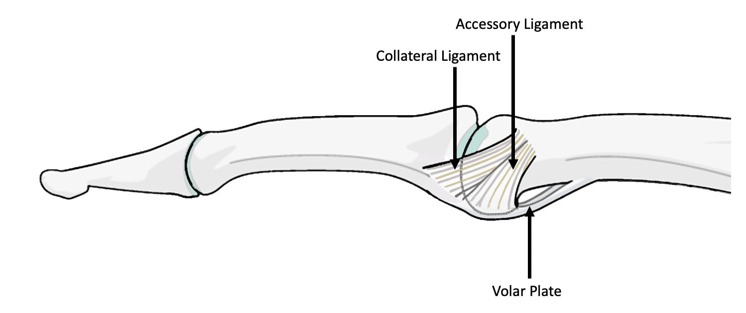 Volar Plate Injuries (Jammed Finger) Proximal Phalangeal Joint ...