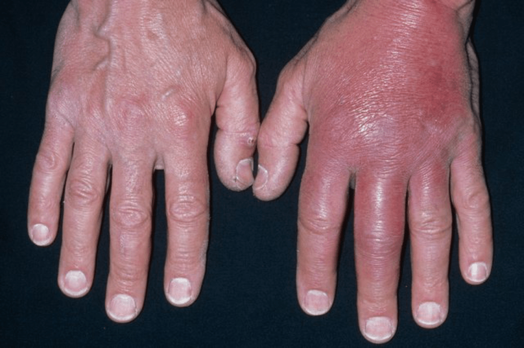 Hand Infections – Lothian Virtual Hand Clinic