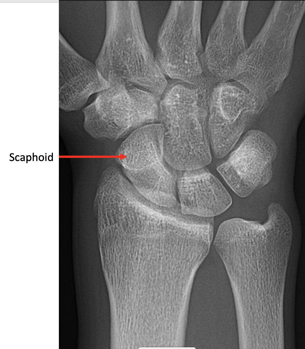 The ‘Query Scaphoid’ Injury – Lothian Virtual Hand Clinic