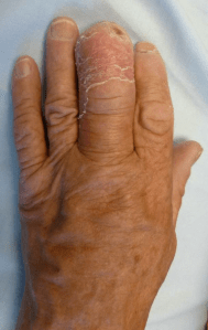Hand Infections – Lothian Virtual Hand Clinic
