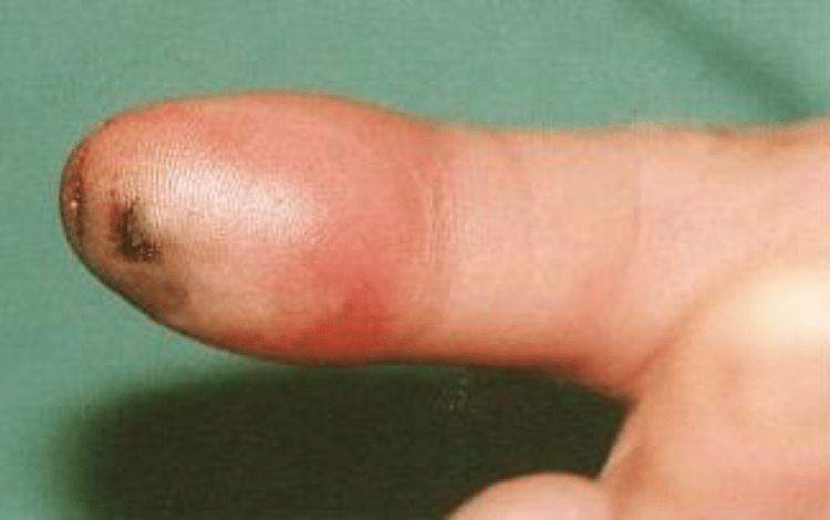 Hand Infections – Lothian Virtual Hand Clinic