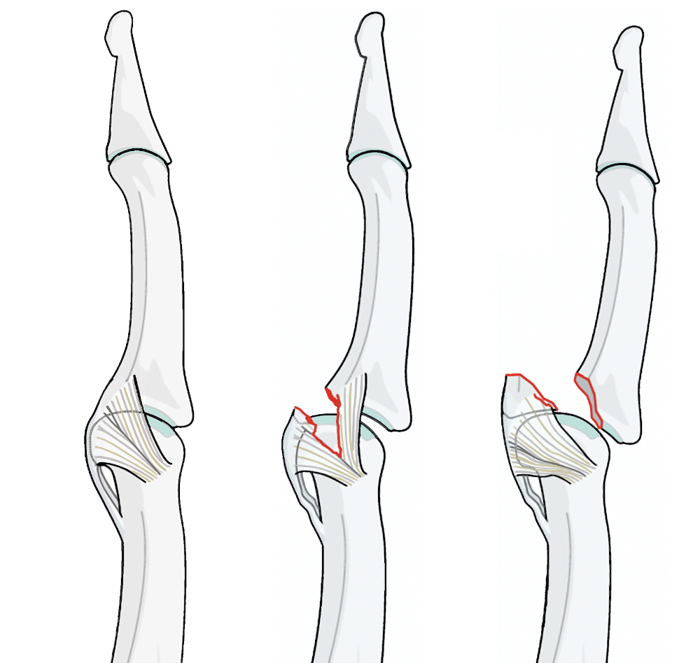 Volar Plate Injuries (Jammed Finger) Proximal Phalangeal Joint ...