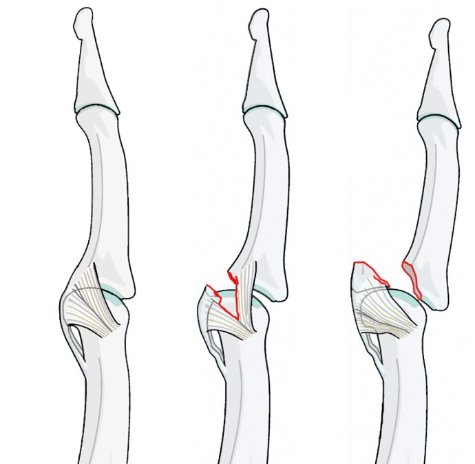 Volar Plate Injuries (Jammed Finger) Proximal Phalangeal Joint ...