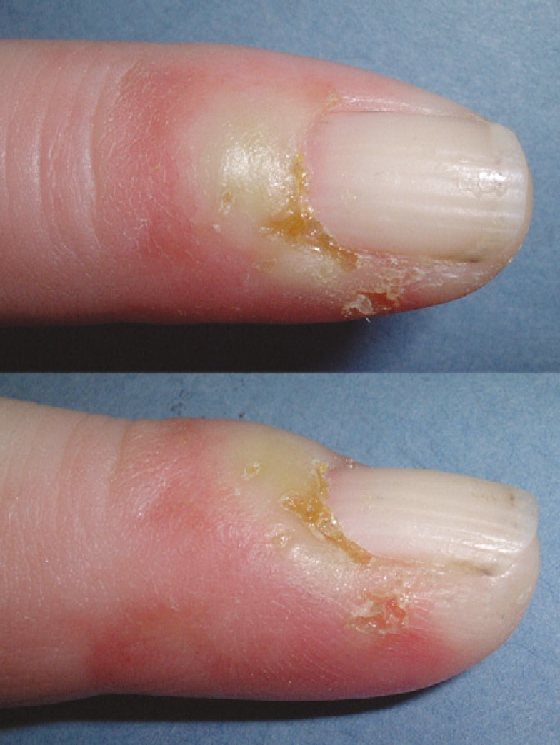 Hand Infections – Lothian Virtual Hand Clinic