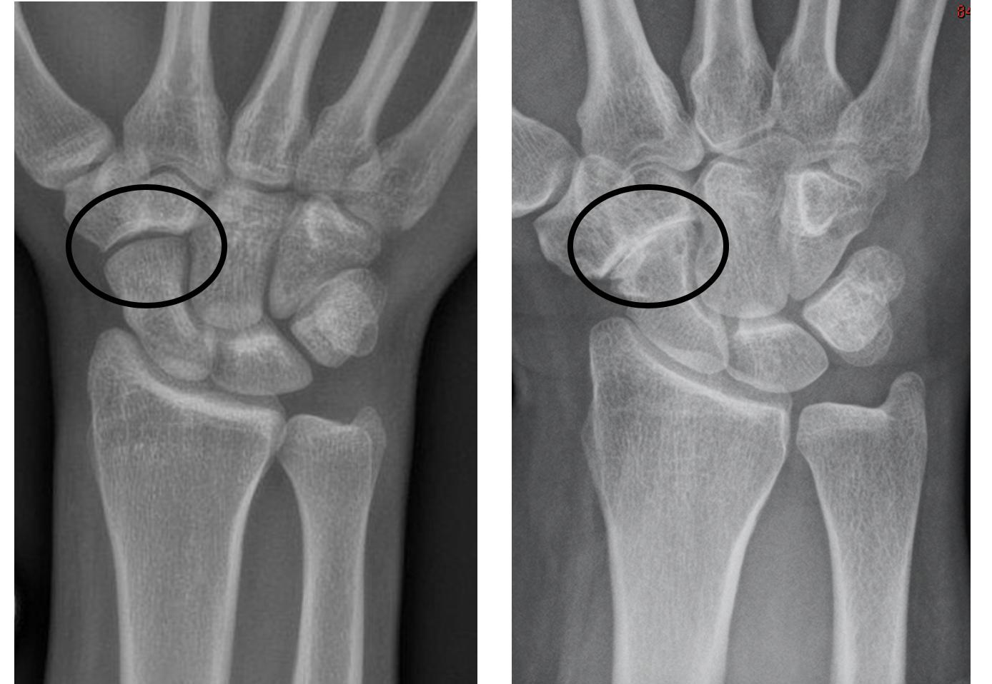 Tri-scaphoid/STT Joint Osteoarthritis – Lothian Virtual Hand Clinic