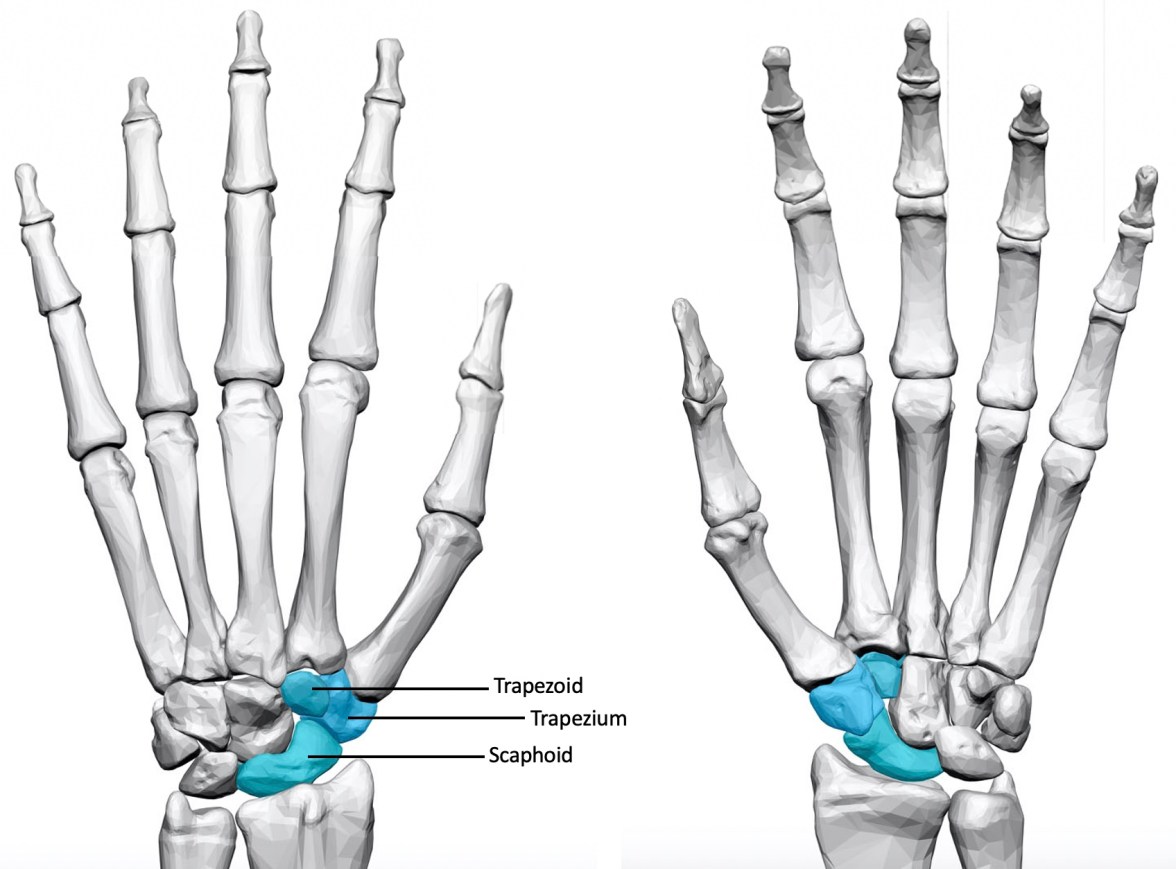Tri-scaphoid/STT Joint Osteoarthritis – Lothian Virtual Hand Clinic